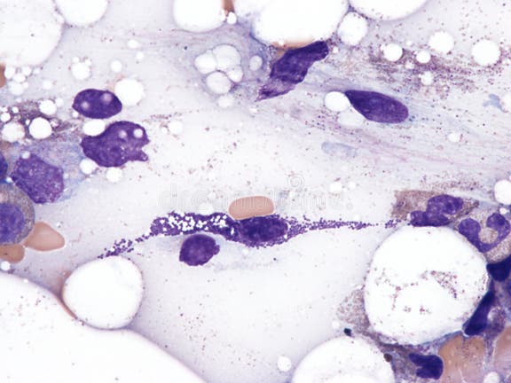 Pathological Mast Cell in Bone Marrow Stock Photo - Image of marrow ...