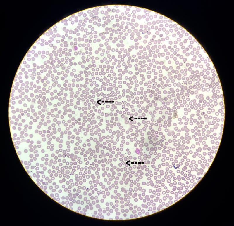 Abnormal Red Blood Cells in Blood Smear Thalassemia Patient Stock Image ...