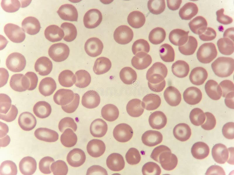Abnormal Shaped Red Blood Cells