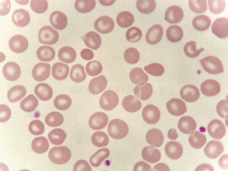 Abnormal Red Blood Cells in Blood Smear Stock Photo - Image of ...