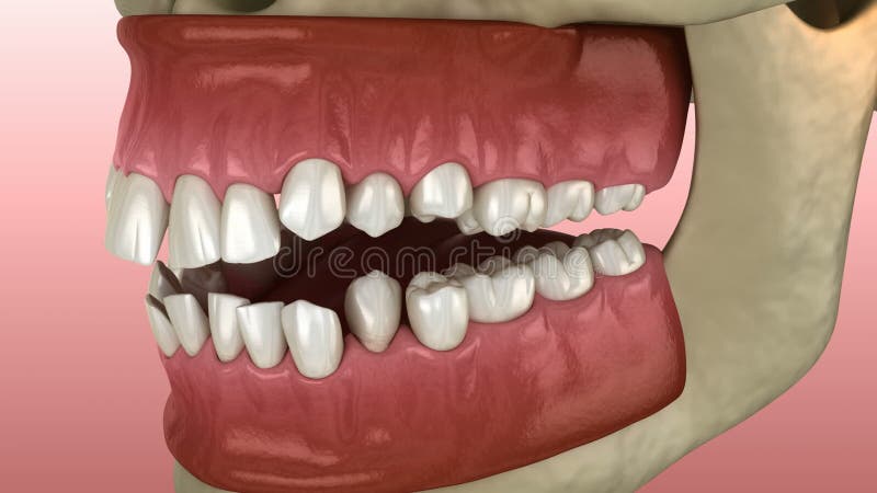 Abnormal Teeth Position, Orthodontic Concept. Medically Accurate Tooth ...