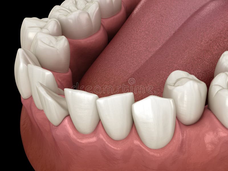 Abnormal Teeth Position, Orthodontic Concept. Medically Accurate Tooth ...