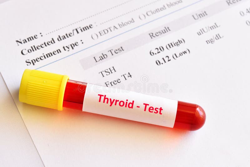 Abnormal Thyroid Hormone Test Result Stock Image - Image of health ...
