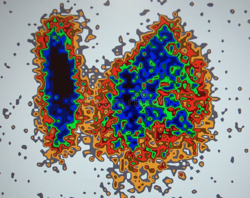 Thyroid pathology scan stock photo. Image of left, level - 34890070