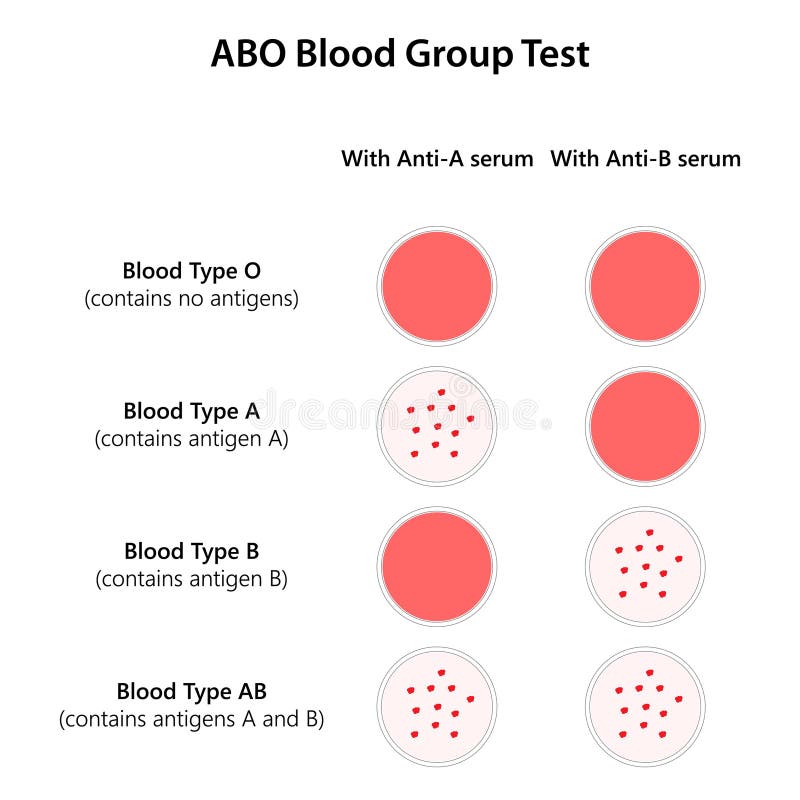 ABO Blood Group System. Blood Groups with Anitigens and Antibodies ...