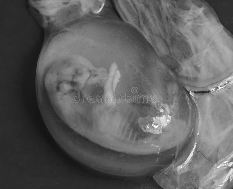 Aborted embryo stock image. Image of anatomy, abortion - 31293889