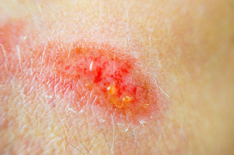 Herida de la abrasión imagen de archivo. Imagen de muestra - 83821687