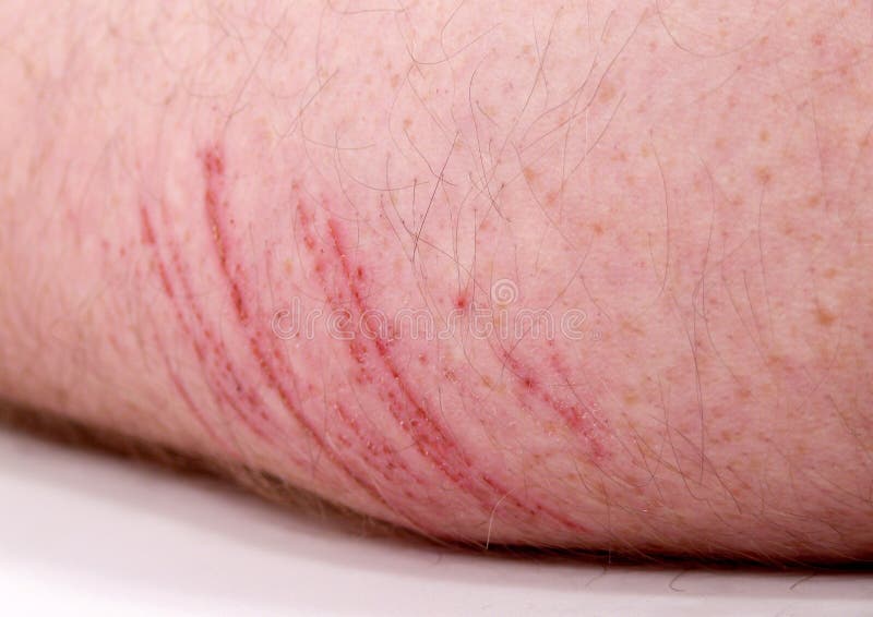 Blessure d'abcès de jambe image stock. Image du rectification - 63785803