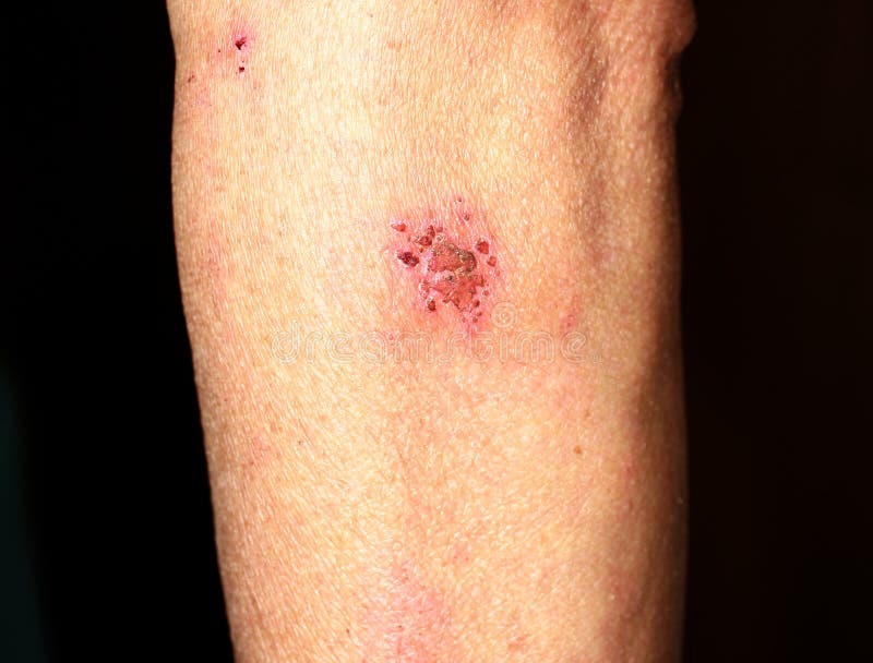 Scraped Up Bleeding Elbow stock photo. Image of health - 9886570