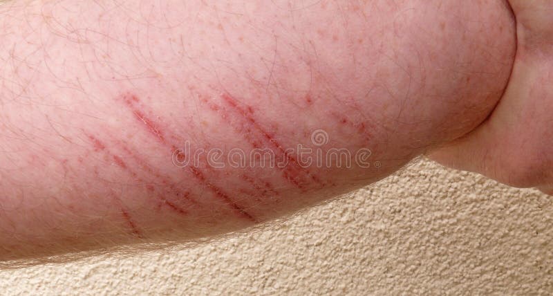 Abrasion stock photo. Image of borderliner, abrasion6 - 51797432