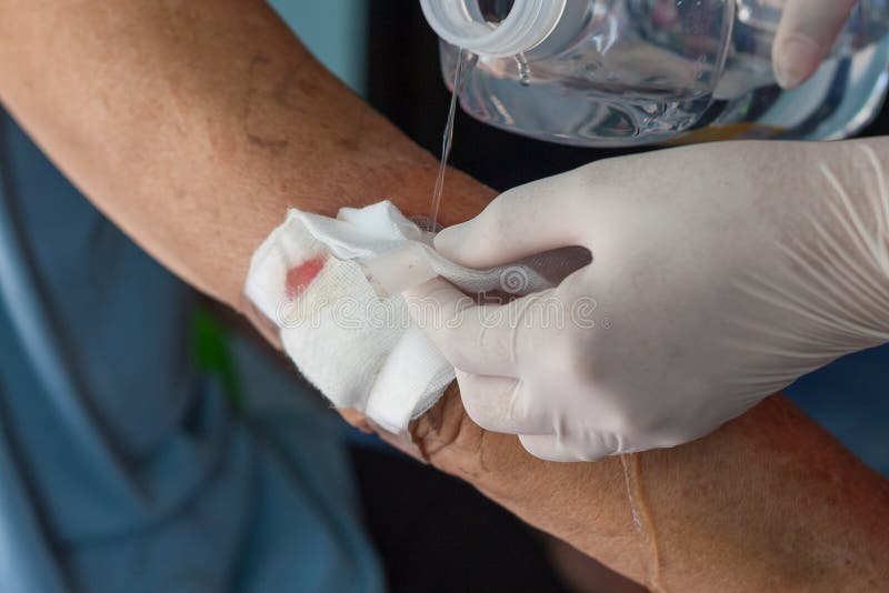 Abrasion wound man stock photo. Image of injury, elbow - 149352634