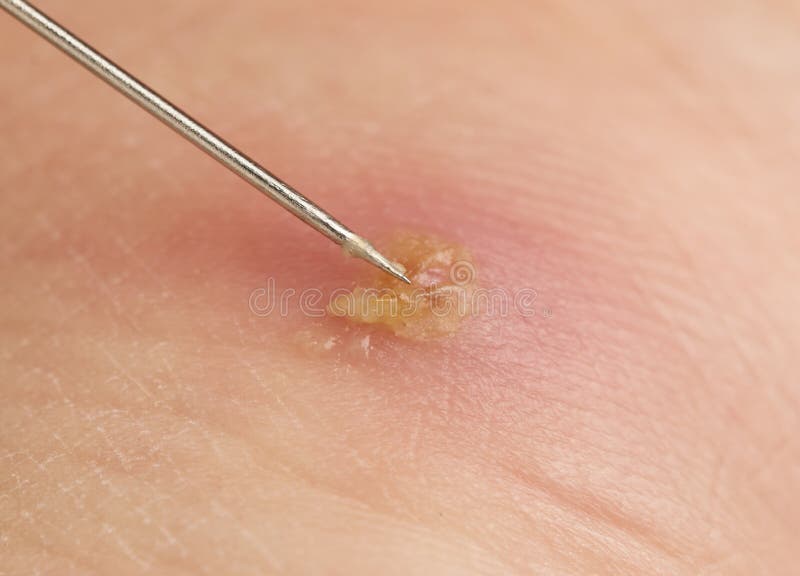 Absceso con pus en la piel foto de archivo. Imagen de absceso - 194937198