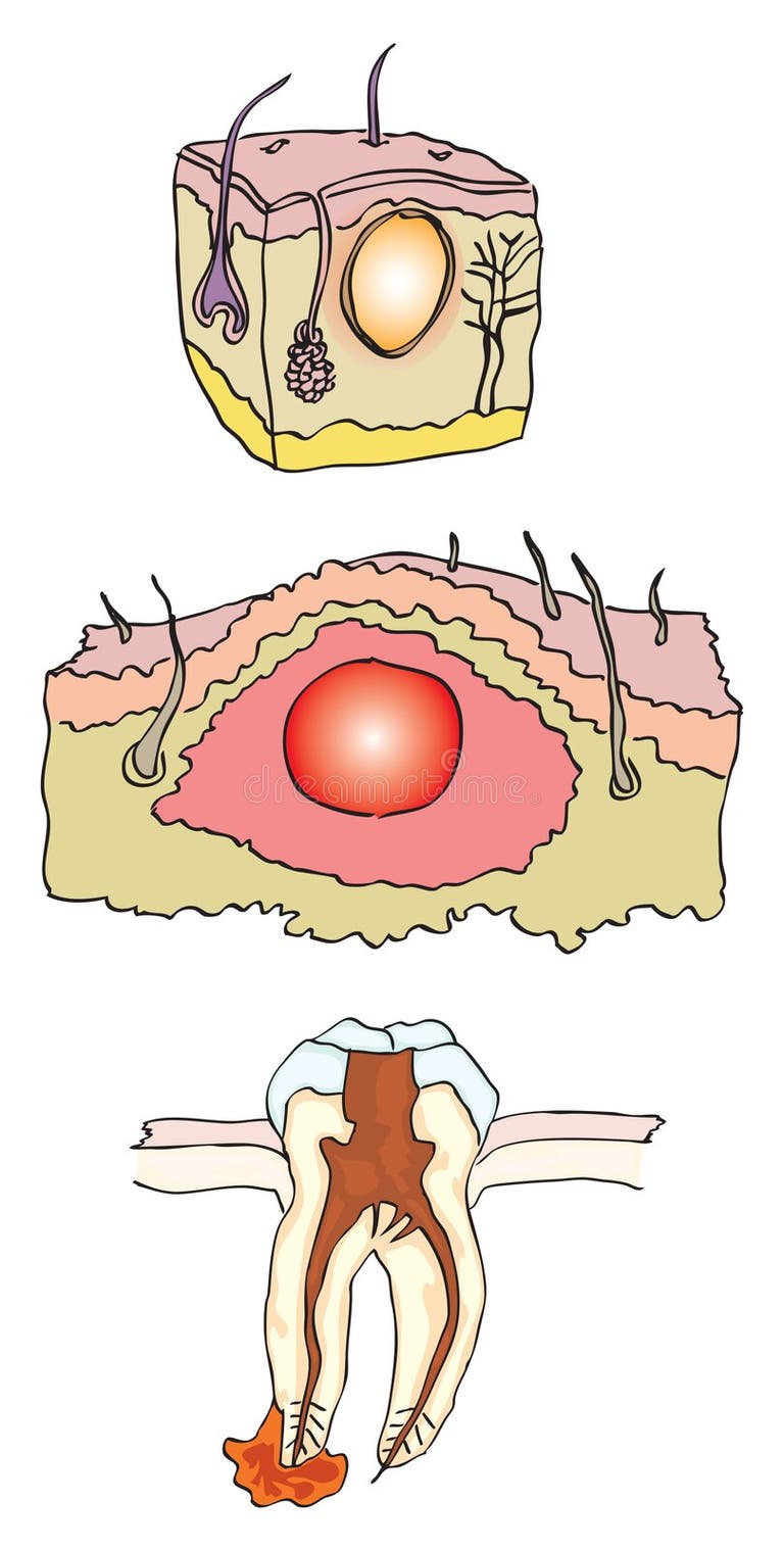 Abscess Stock Illustrations – 2,343 Abscess Stock Illustrations ...