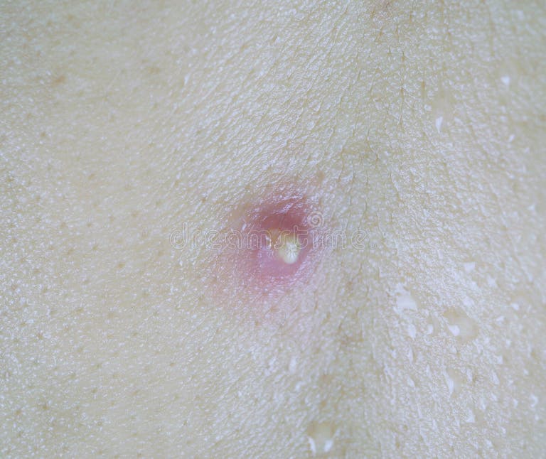 Abscess at back stock photo. Image of pustule, inflammation - 53252484