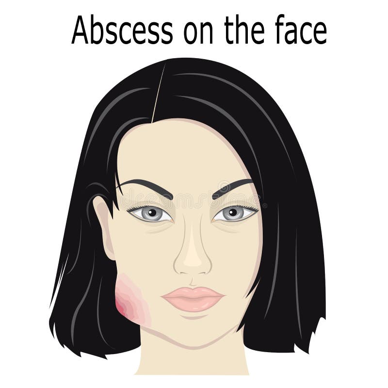 Abscess on the face stock vector. Illustration of anatomy - 82725359