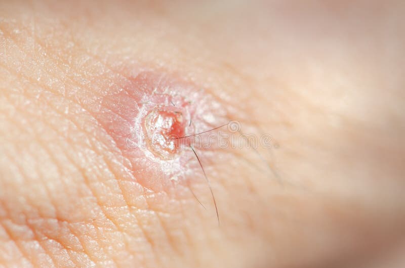 Abscess on Man Hand,select Focus. Stock Image - Image of focus, focusn ...