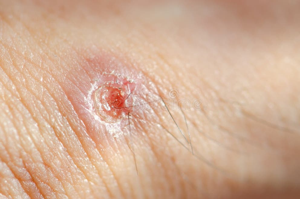 Abscess on Man Hand,select Focus. Stock Photo - Image of closeup ...