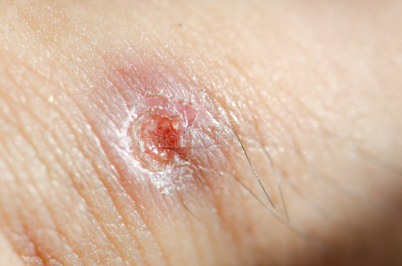 693 Abscess Hand Stock Photos - Free & Royalty-Free Stock Photos from ...
