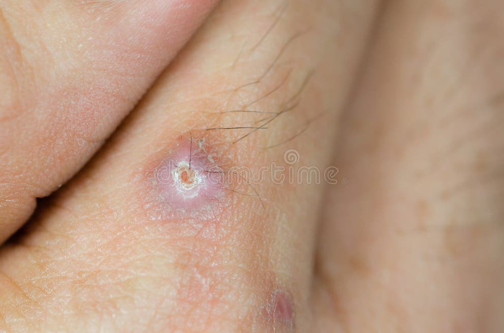 Abscess on Man Hand,select Focus. Stock Image - Image of inflammation ...