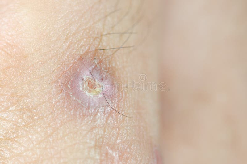 Abscess on Man Hand,select Focus. Stock Image - Image of focusn ...