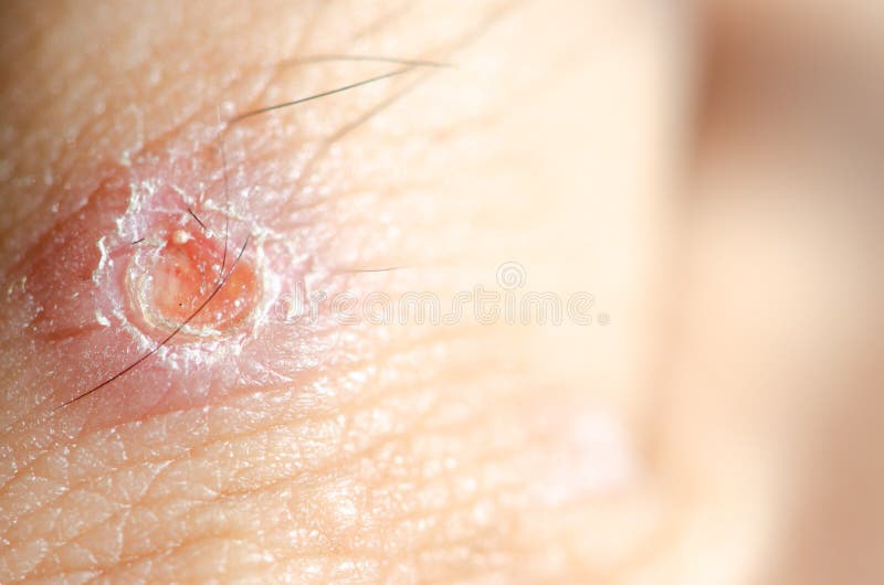 Abscess On Man Hand,select Focus. Stock Photo - Image of closeup ...