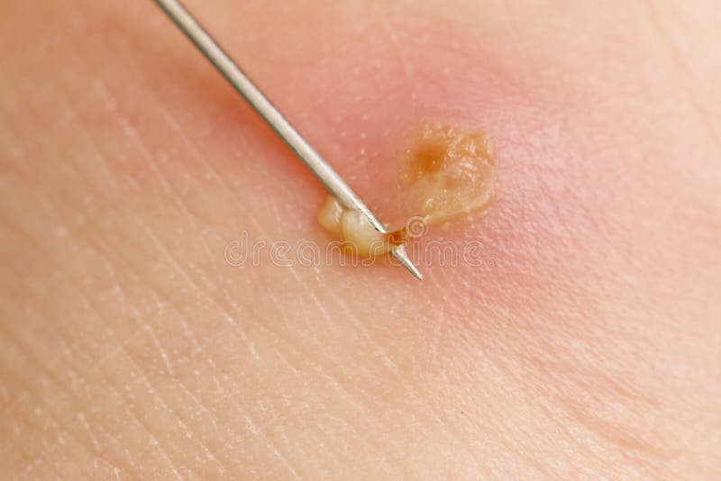 Abscess with Pus on the Skin Stock Image - Image of abscess, thorn ...