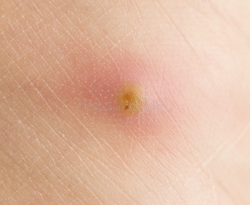 Abscess with Pus on the Skin Stock Image - Image of thorn, injury ...