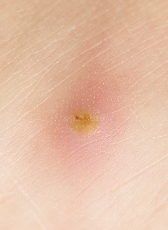 1,637 Abscess Photos - Free & Royalty-Free Stock Photos from Dreamstime