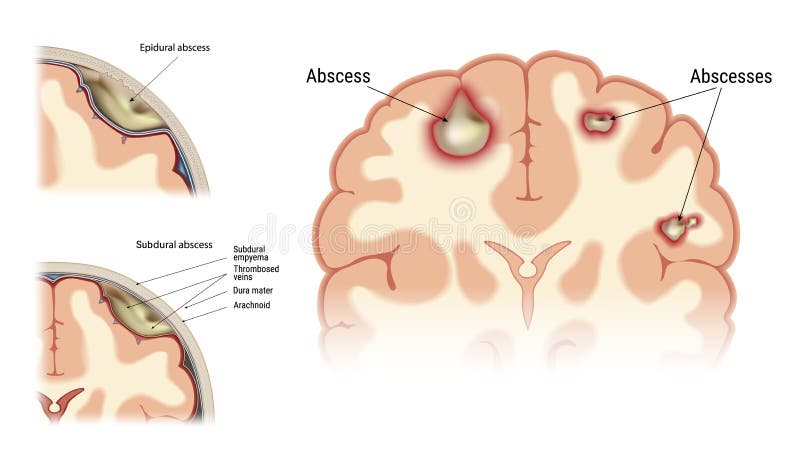 Brain Abscess. Cerebral Abscess. Cross Section of a Human Brain with ...