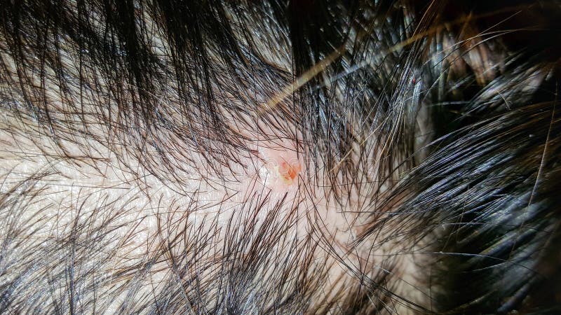 Abscess on skin head stock photo. Image of blood, illness - 103441504