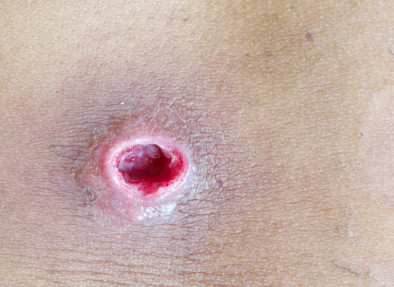 Abscess wound stock image. Image of abscess, medicine - 43444613