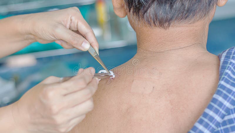 Abscess wound stock image. Image of blood, skin, doctor - 43444613