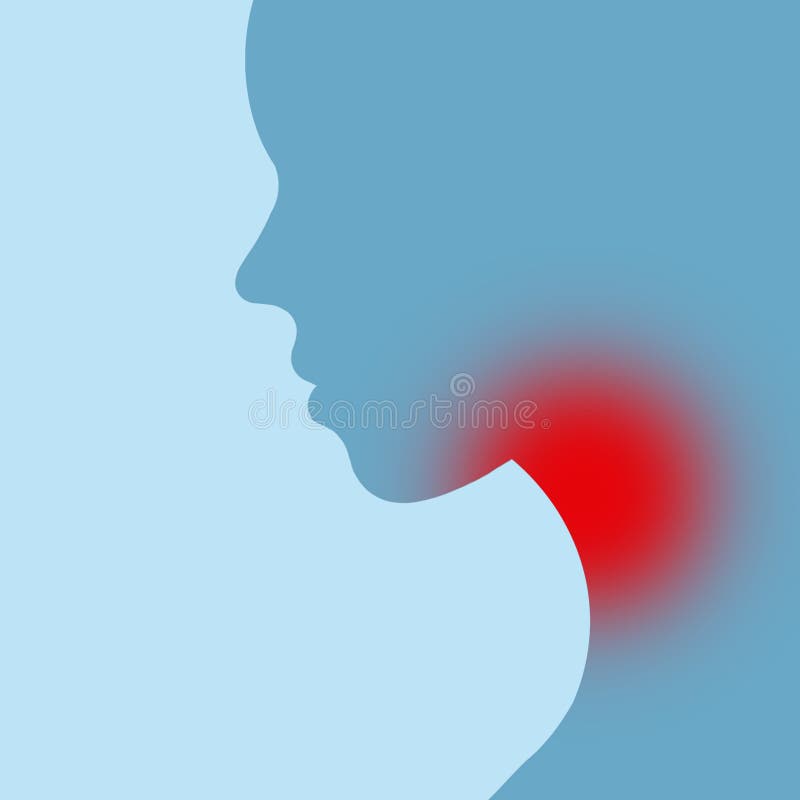 Illustration of Sore Throat Stock Illustration - Illustration of ...