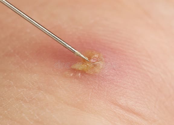 Abszess Mit Eiter Auf Der Haut Stockfoto - Bild von dorn, eiter: 194937198