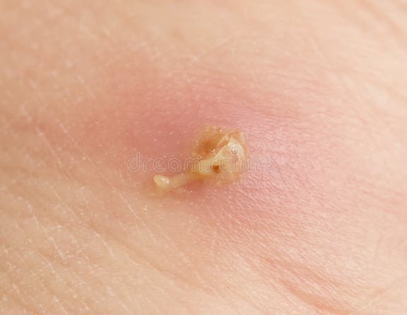 Abszess Mit Eiter Auf Der Haut Stockfoto - Bild von eiter, dorn: 194937206