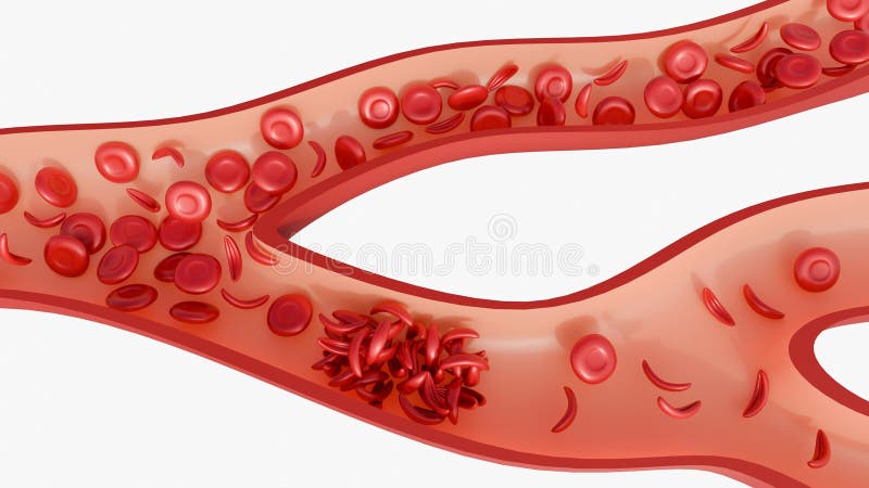 AC Blood Vessel with a Cluster of Sickle Cells Obstructing the Flow of ...