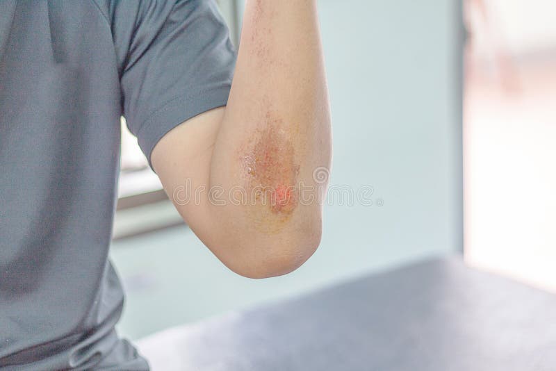Abrasion Wound Stock Photos - Download 891 Royalty Free Photos