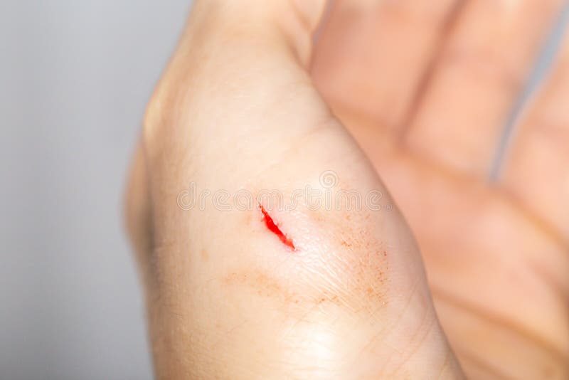 Deep cut in the skin stock image. Image of digit, healthcare - 186296325