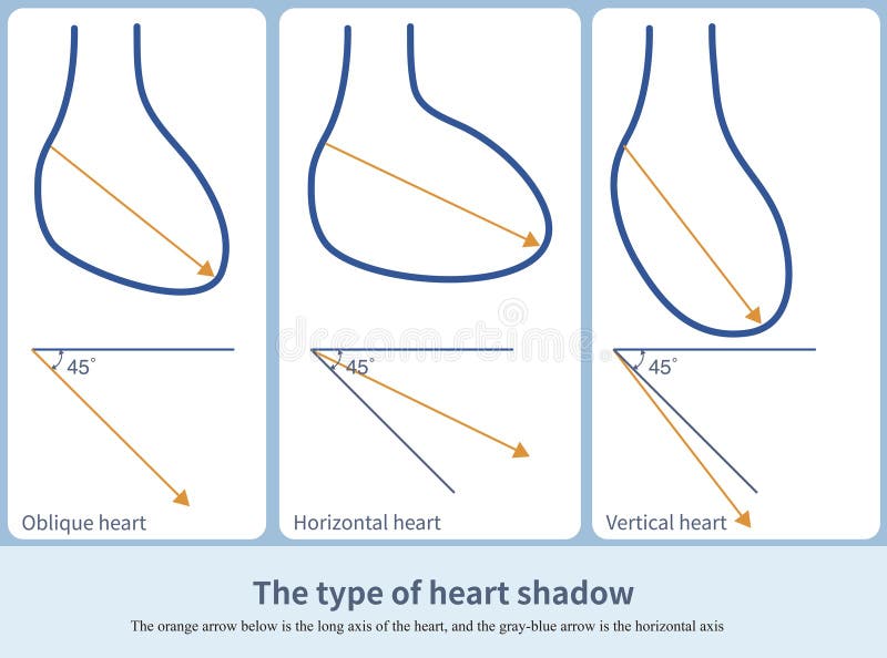 The type of heart shadow stock image. Image of axis - 361197859