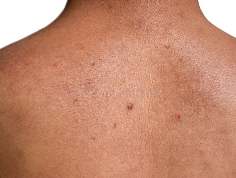 Backne Stock Photos - Free & Royalty-Free Stock Photos from Dreamstime