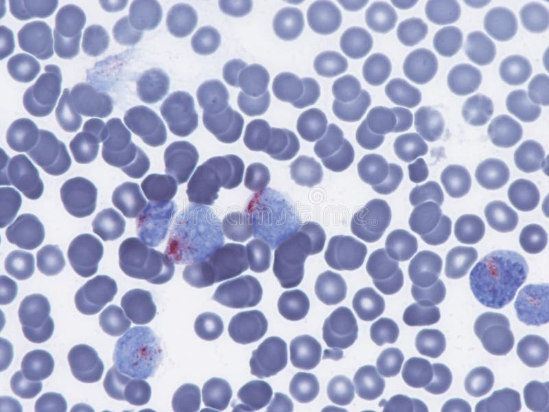 Acid Phosphatase in a Case of T Lymphoblastic Leukemia Stock ...