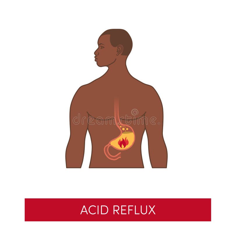 Acid reflux disease stock illustration. Illustration of cartoon - 102157698