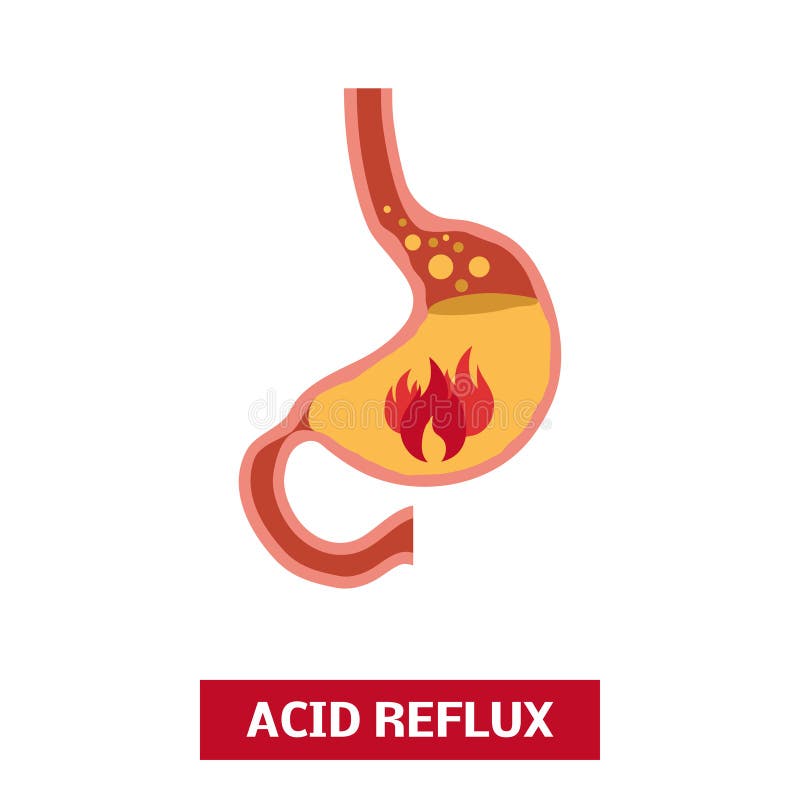 Reflux Symbol Stock Illustrations – 1,206 Reflux Symbol Stock ...