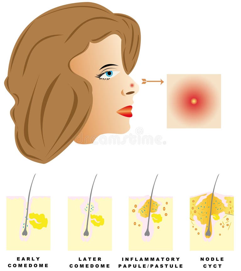 Acne Papule Stock Illustrations – 1,140 Acne Papule Stock Illustrations ...