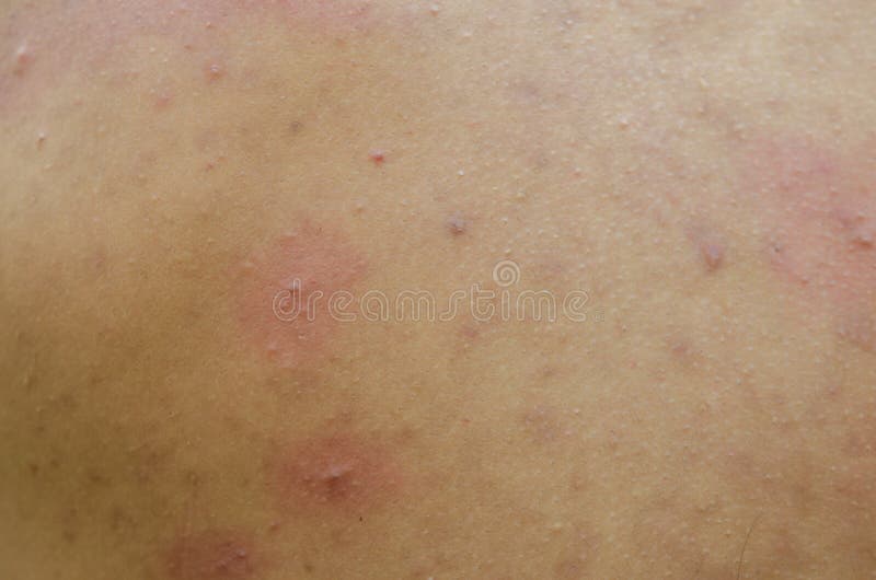 Acne on the back stock photo. Image of pimple, skincare - 176436532