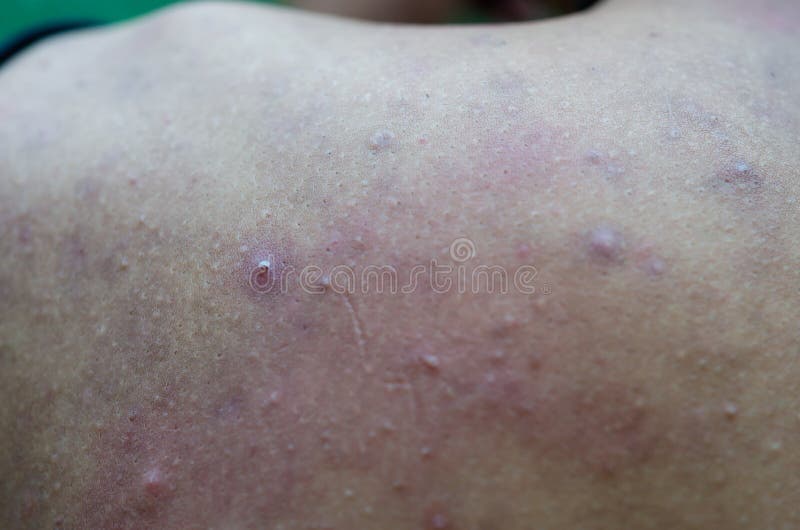 Acne on the back stock image. Image of rash, health - 176437103