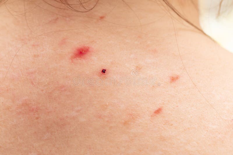 Acne on the Back and Skin Problems Stock Photo - Image of female ...