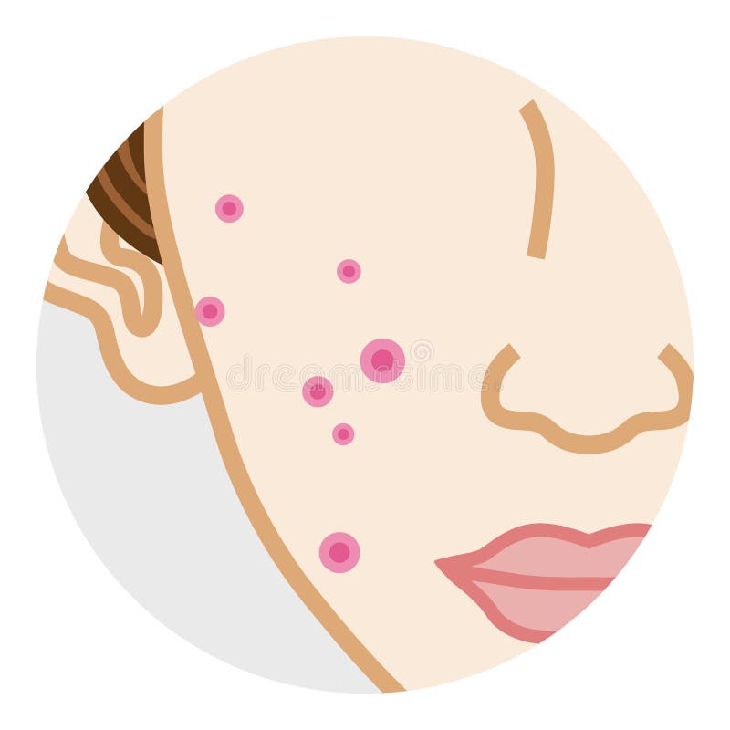 Acne - Cheek Body Part stock vector. Illustration of face - 91297324