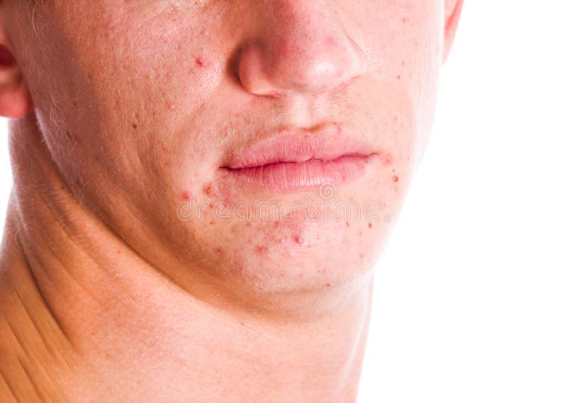 Acne Face Stock Images - Image: 12123344
