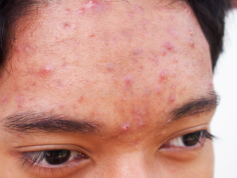 Acne on Face Teenage Asian Boy. Stock Photo - Image of facial ...